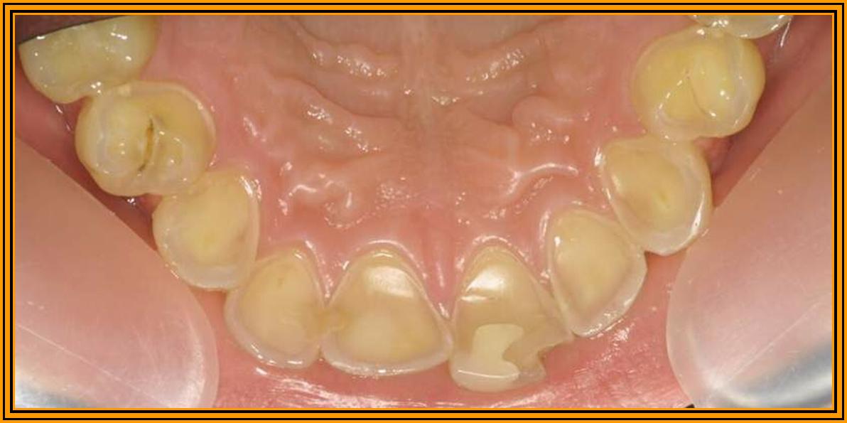 What You Need To Know About Drinking Alcohol and Your Teeth | NACCID