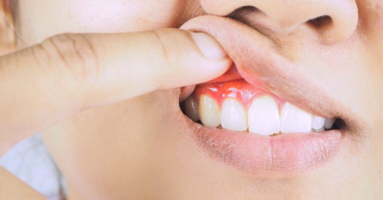 How Far Can Gums Recede Before Teeth Fall Out? A Complete Guide ...