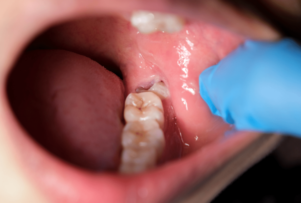 Can You Drink Soda After Wisdom Teeth Removal? Why Not? - Buford Dentist