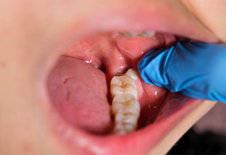 When Can You Eat Chips After Wisdom Teeth Removal? - Buford Dentist