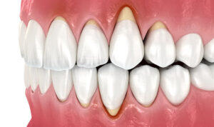 How Far Can Gums Recede Before Teeth Fall Out? A Complete Guide ...