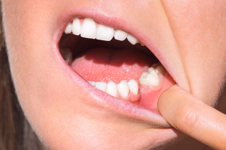 Can Wisdom Teeth Grow Back or Are They Completely Gone? - Buford Dentist