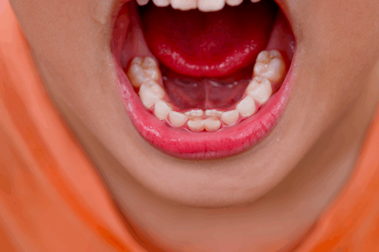 Can Wisdom Teeth Grow Back or Are They Completely Gone? - Buford Dentist