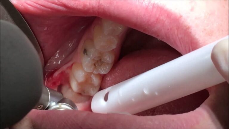 Can Wisdom Teeth Grow Back or Are They Completely Gone? - Buford Dentist