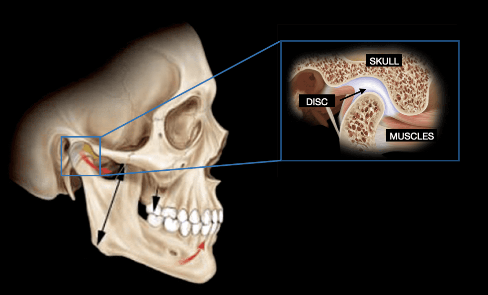 Can Wisdom Teeth Cause Tmj Yes And No—heres Why Naccid